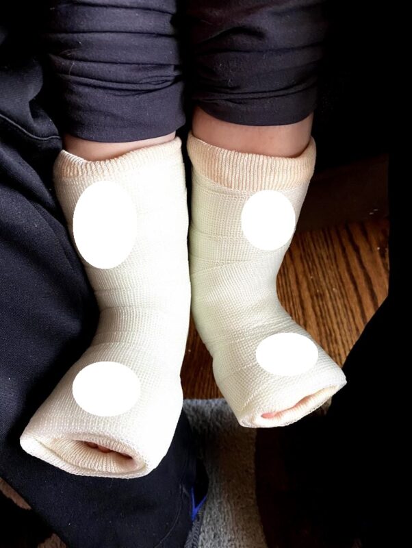 Idiopathic Toe Walking & Pediatric Therapy - Milestone Therapy Blog