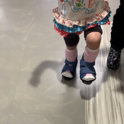 Learn about pediatric serial casting - Milestone Therapy