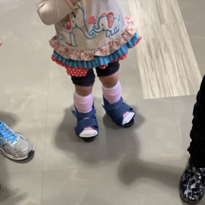 A Parent's Perspective on Serial Casting - Milestone Therapy